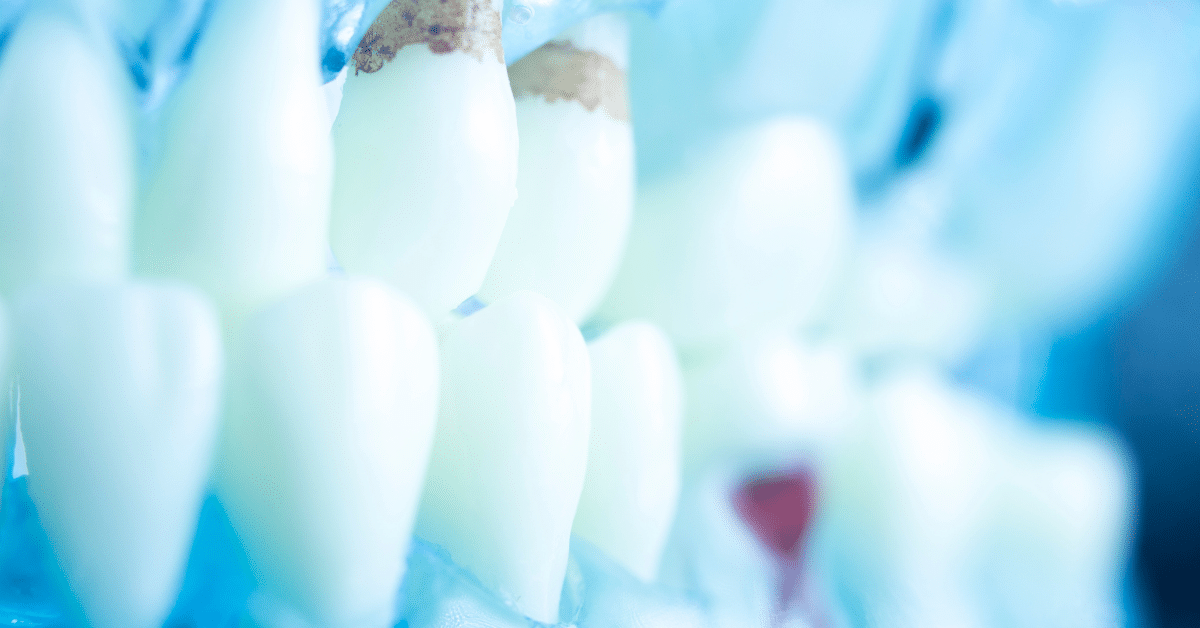 How To Clean And Prevent Plaque In Mouth?